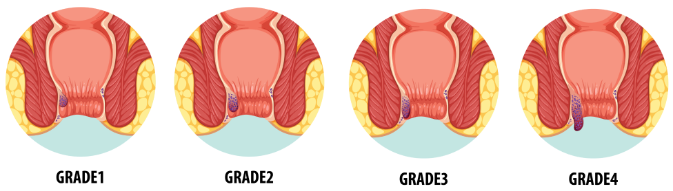 Hemorrhoid Artery Embolization | Astra Vein & Vascular