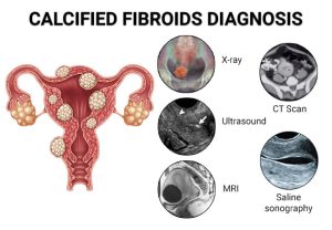 Calcified Fibroids Treatment in Brooklyn, NY and Bronx, NY - Vein ...