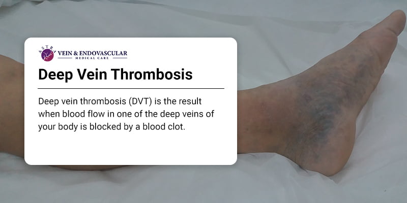 Deep Vein Thrombosis (DVT) - Vein & Endovascular Medical Care