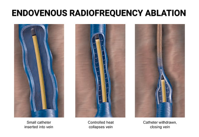 Endovenous Radiofrequency Ablation (RFA) - Vein & Endovascular Medical Care Endovenous Radiofrequency Ablation (RFA) - Vein & Endovascular Medical Care