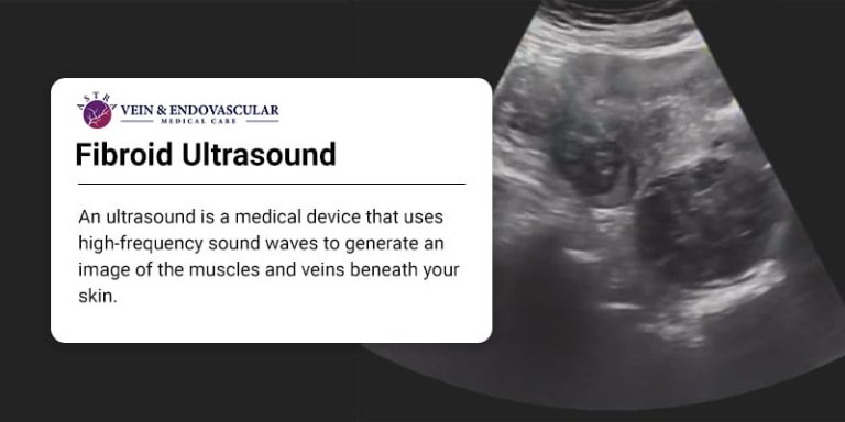 Fibroid Ultrasound - Vein & Endovascular Medical Care