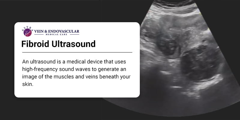 Fibroid Ultrasound - Vein & Endovascular Medical Care