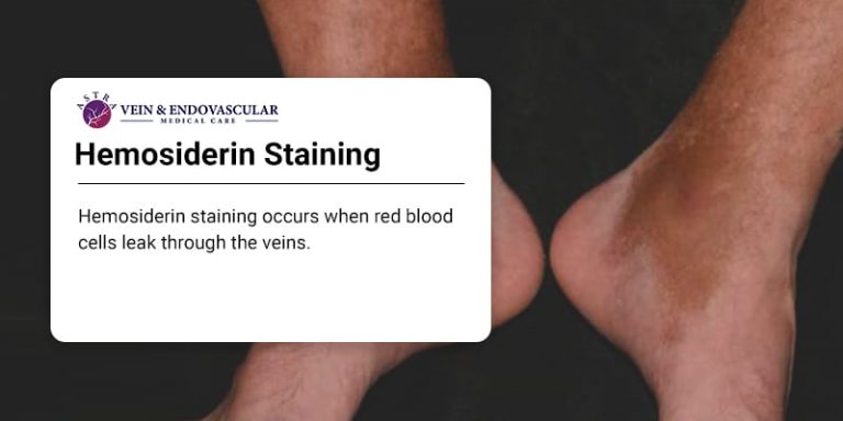 Hemosiderin Staining – Why Your Legs Are Turning Brown? - Vein ...