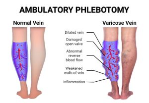 Ambulatory Phlebotomy Brooklyn & Bronx - Vein & Endovascular Medical Care