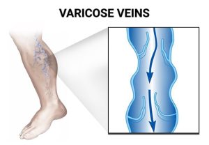 Varicose Veins Removal Doctor in Brooklyn, NY and Bronx, NY | Varicose ...