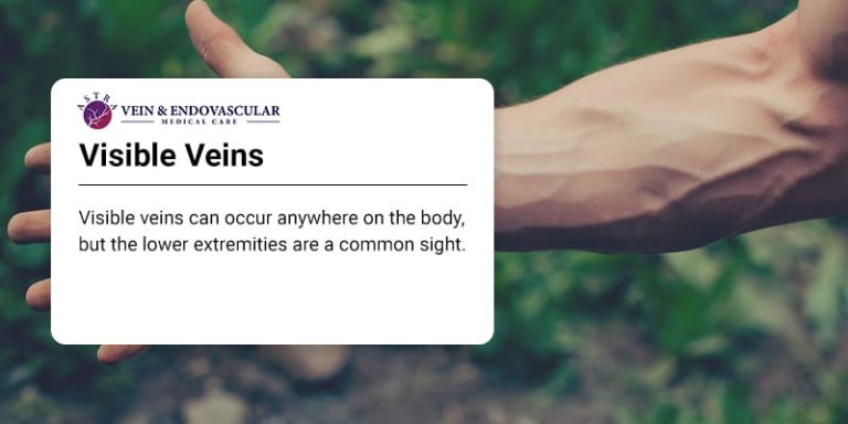 Why Are My Veins So Visible? - Vein & Endovascular Medical Care Why Are My Veins So Visible? - Vein & Endovascular Medical Care
