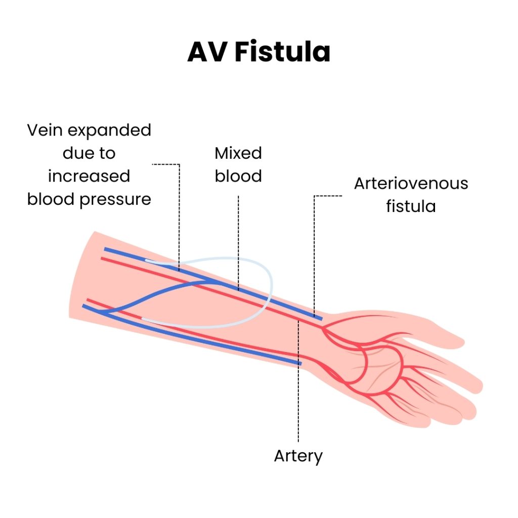 AV Fistula Creation in Brooklyn, NY & Bronx, NY - Vein & Endovascular ...
