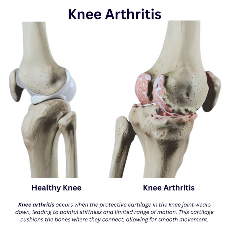 Knee Arthritis Treatment in Brooklyn, Bronx | Vein & Endovascular ...